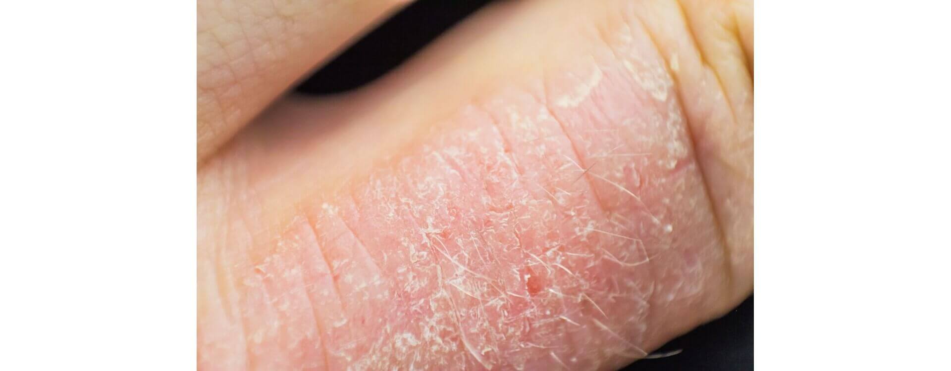 Psoriasis main ou pied : Que faire